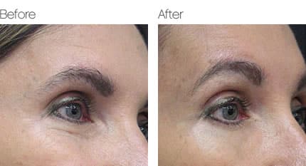 Facial Contouring Accent Ultra V-Shape | Eliza Facialist