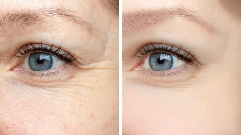 Fine lines and wrinkles, laxity & sagging - Eliza Facialist